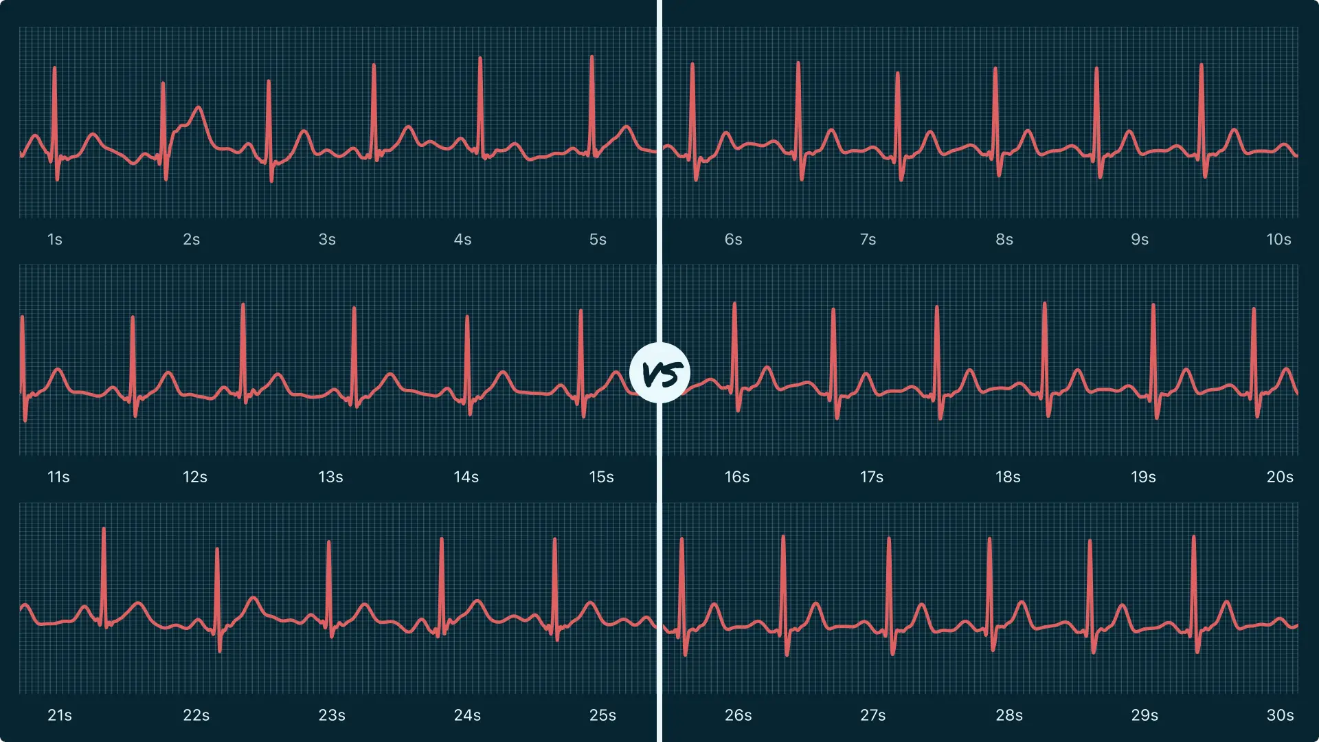 Sinus Rhythm Vs. First Degree AV Block on Your Watch ECG | Qaly